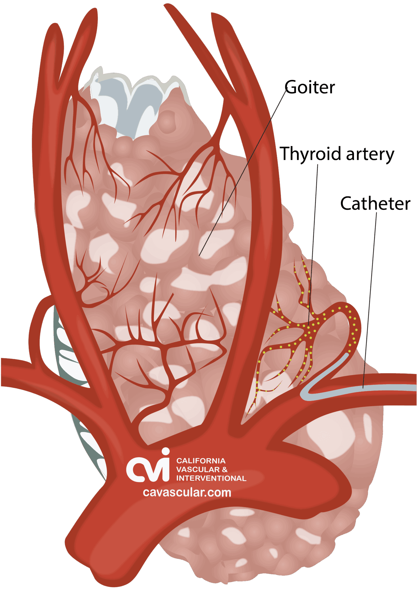 Thyroid Goiter Embolization Treatment | CVI Thyroid Center