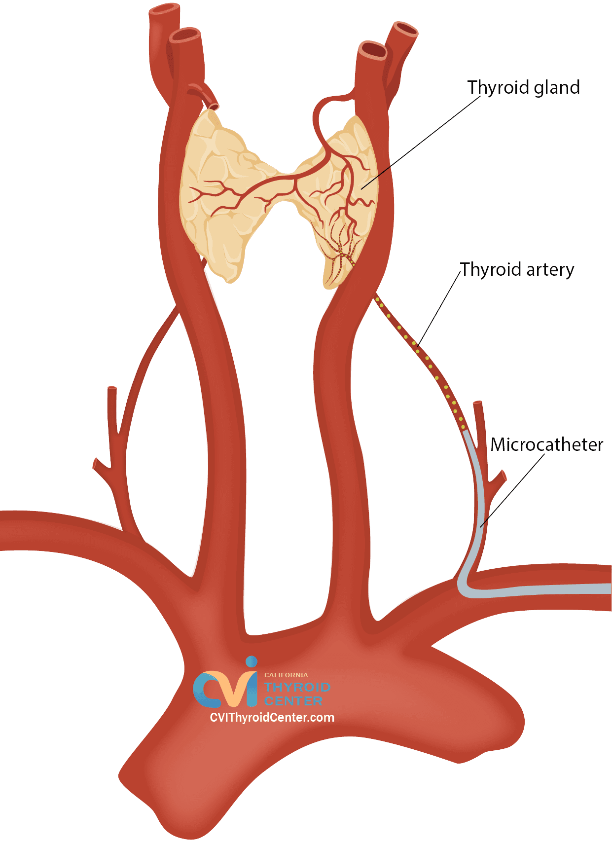 Graves' Treatment - Non-Surgical Thyroid Artery Embolization