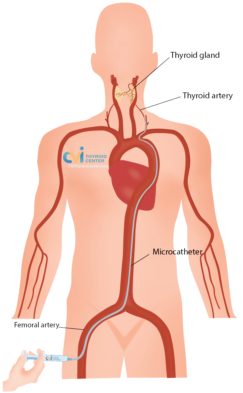 Graves' Treatment - Non-Surgical Thyroid Artery Embolization